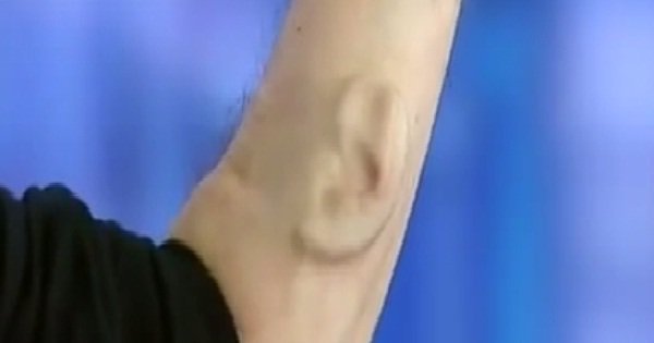 This Man Grew An Ear On His Arm To Let Others Hear What The Ear Is ...