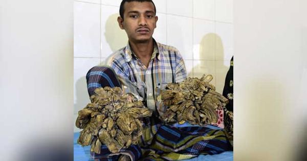 Bangladesh’s ‘Tree Man’ Now Hopes To Lead Normal Life After Successful ...