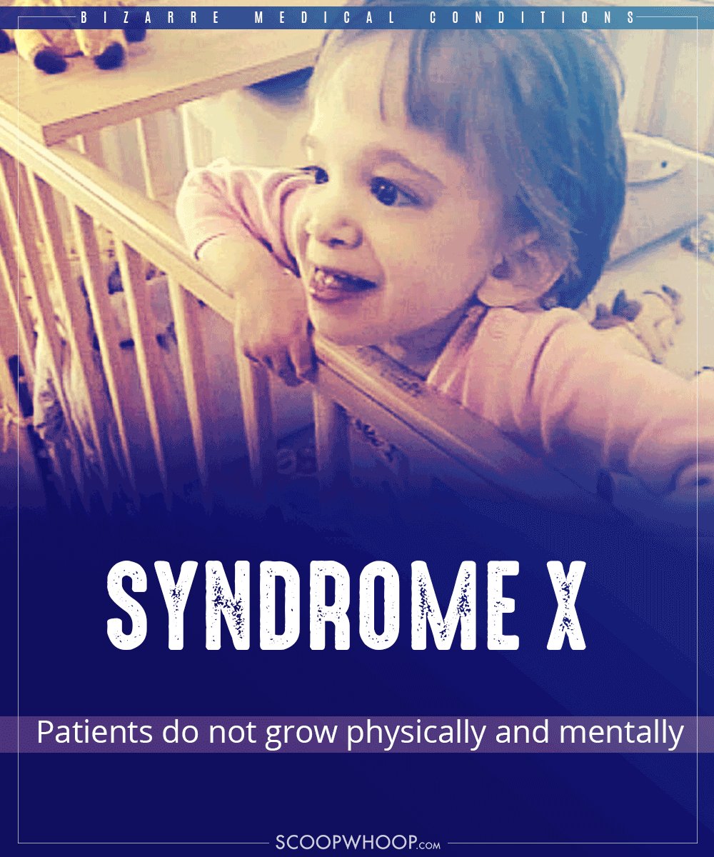 15 Rare Medical Conditions That Are As Bizarre As They Are Fascinating