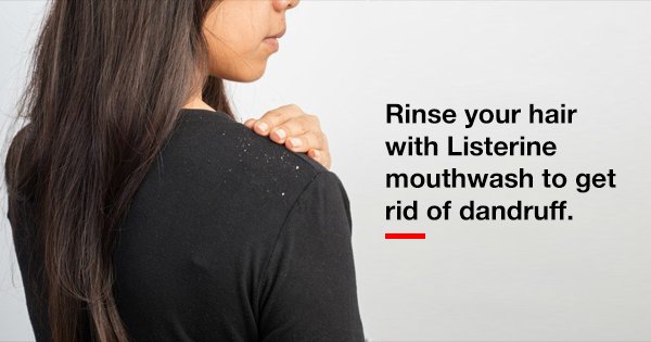 These 12 Easy Ways Will Help You Get Rid Of Dandruff & Flaky Scalp