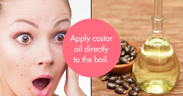 6 Home Remedies To Get Rid Of Painful Heat Boils - ScoopWhoop