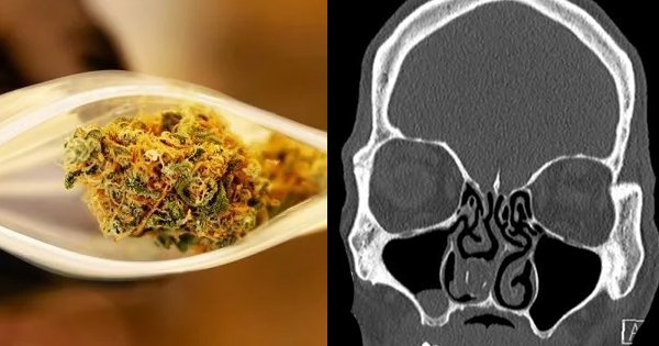 Bag Of Weed Had To Be Surgically Removed From This Convict's Nose After ...