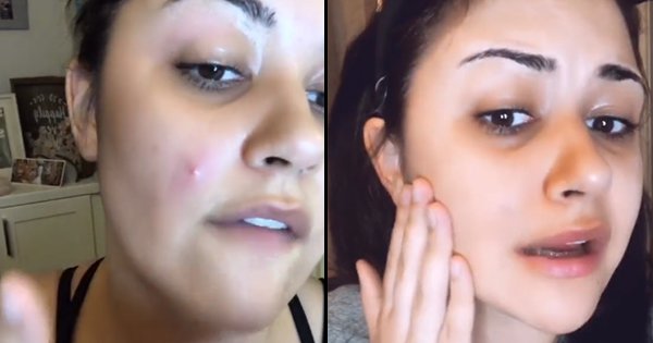 This TikTok User's Hack For Acne Is Here To Save Some Lives