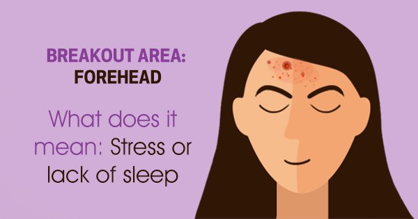 This Acne Face Map Will Help You Understand What The Placement Of Your ...