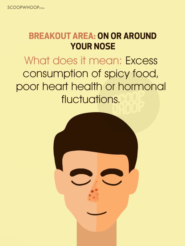 This Acne Face Map Will Help You Understand What The Placement Of Your ...