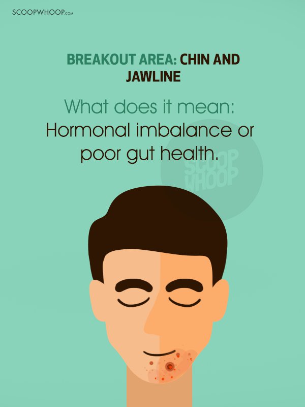 This Acne Face Map Will Help You Understand What The Placement Of Your ...