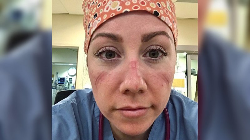 The Side Effects Of Wearing Masks On Your Skin