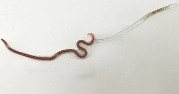 Woman Visits Doctor For An Itchy Throat, Finds A Worm Living In Tonsil
