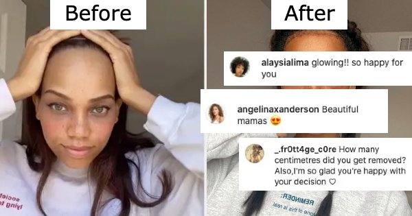 This Model Got A Forehead Reduction Surgery & Insta Was Her Supportive ...