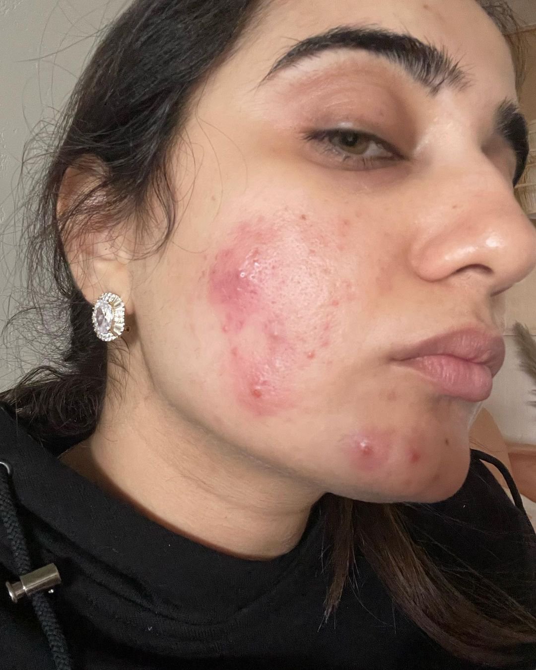 Kusha Kapila's Instagram Post On Hormonal Acne Is Raw, Real And Relatable